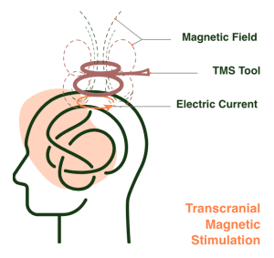 Transcranial Magnetic Stimulation (TMS) - Foresight Mental Health